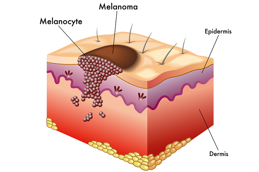 Distinguishing Age Spots From Melanoma – Morada Senior Living